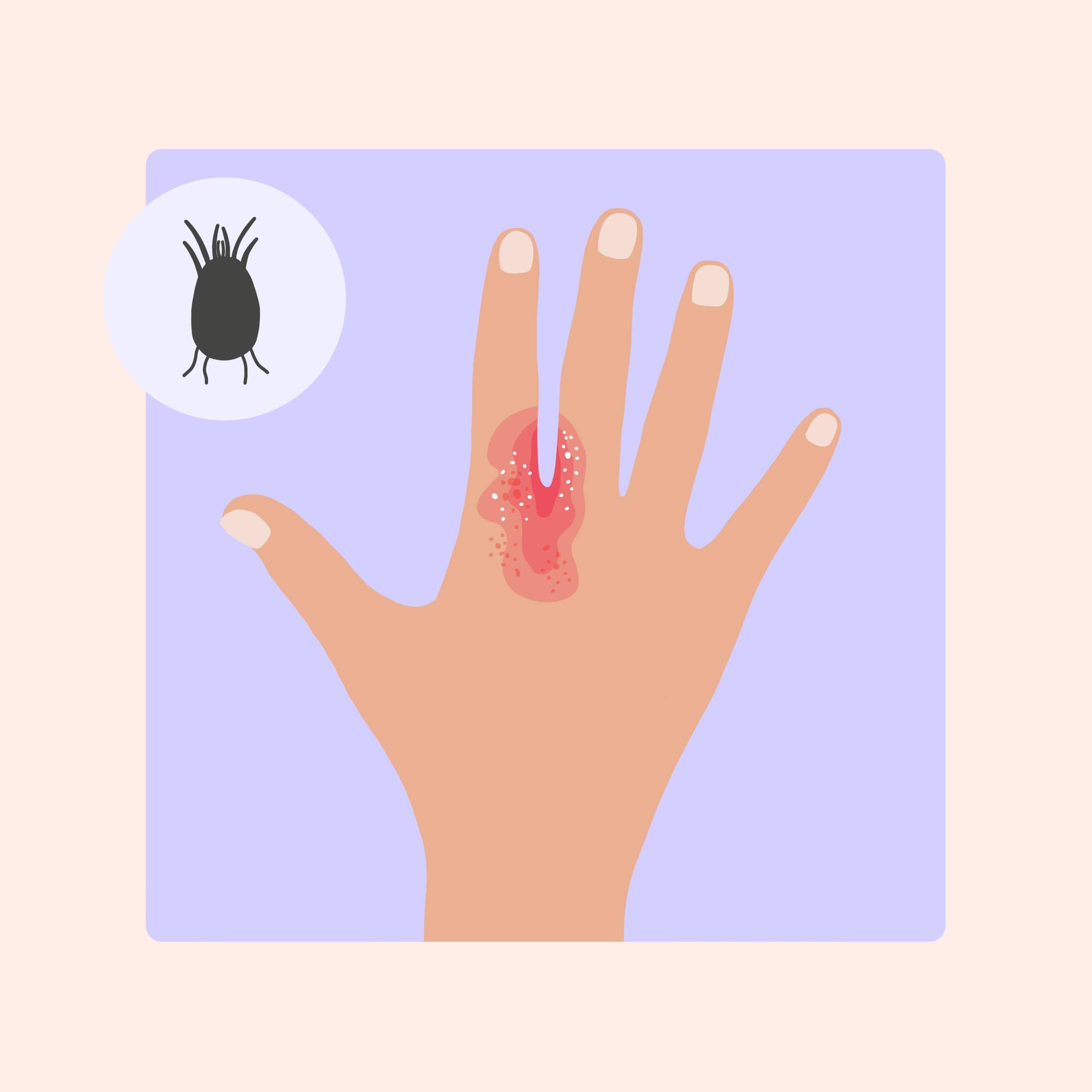 La gale : causes, symptômes et traitements | Redcare PHARMACIE