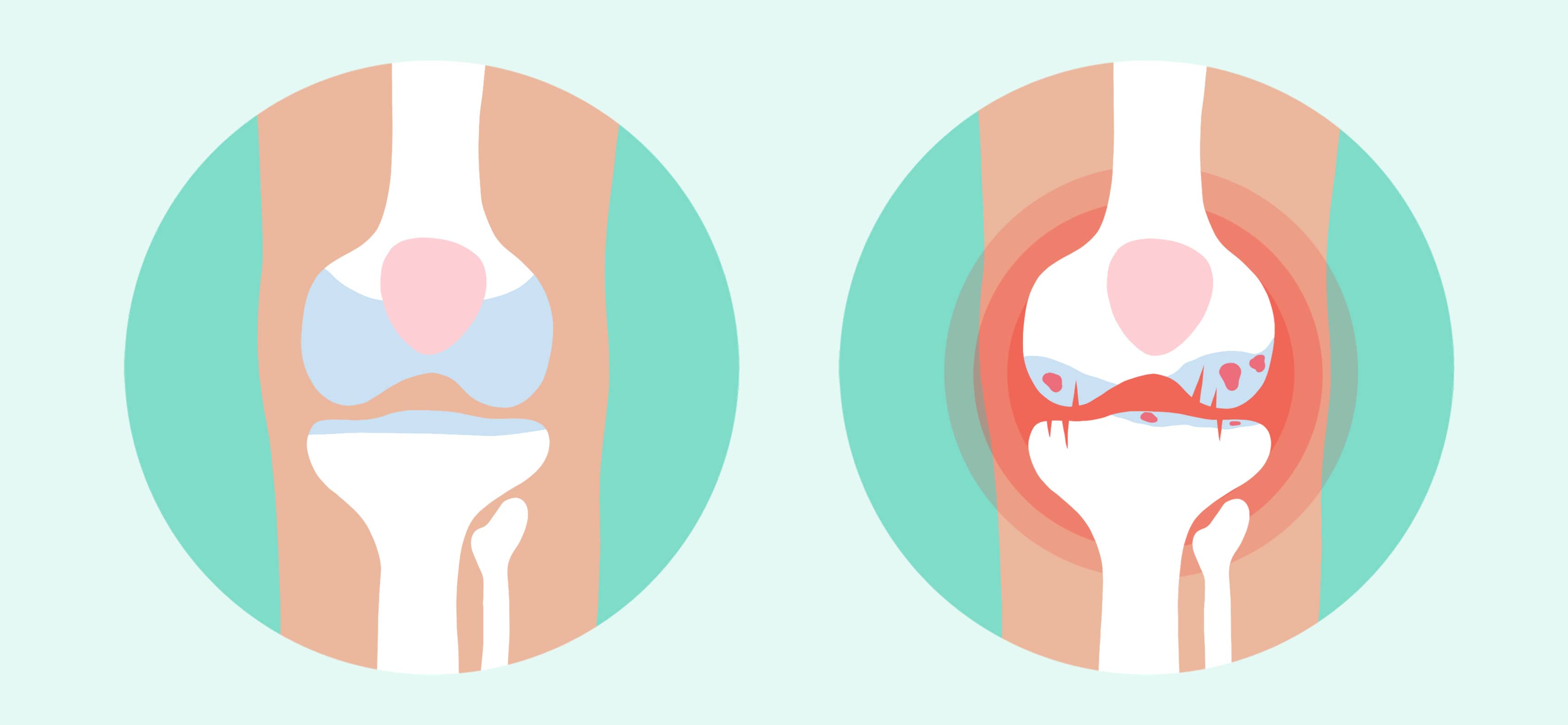 Arthrose : symptômes et traitement | Redcare PHARMACIE