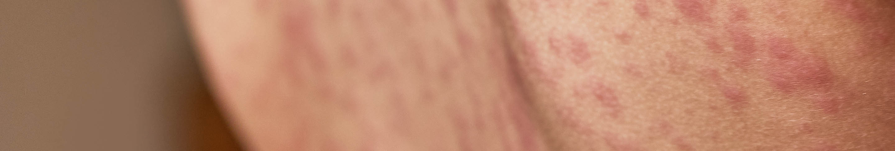 Pityriasis rosé - Causes, symptômes et traitement | Redcare Pharmacie